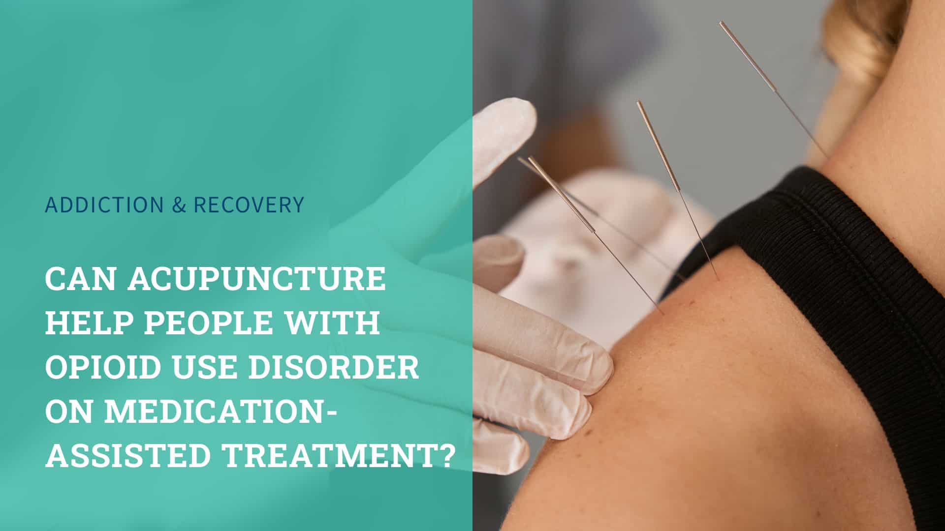 Acupuncture for Opioid Use Disorder Treatment